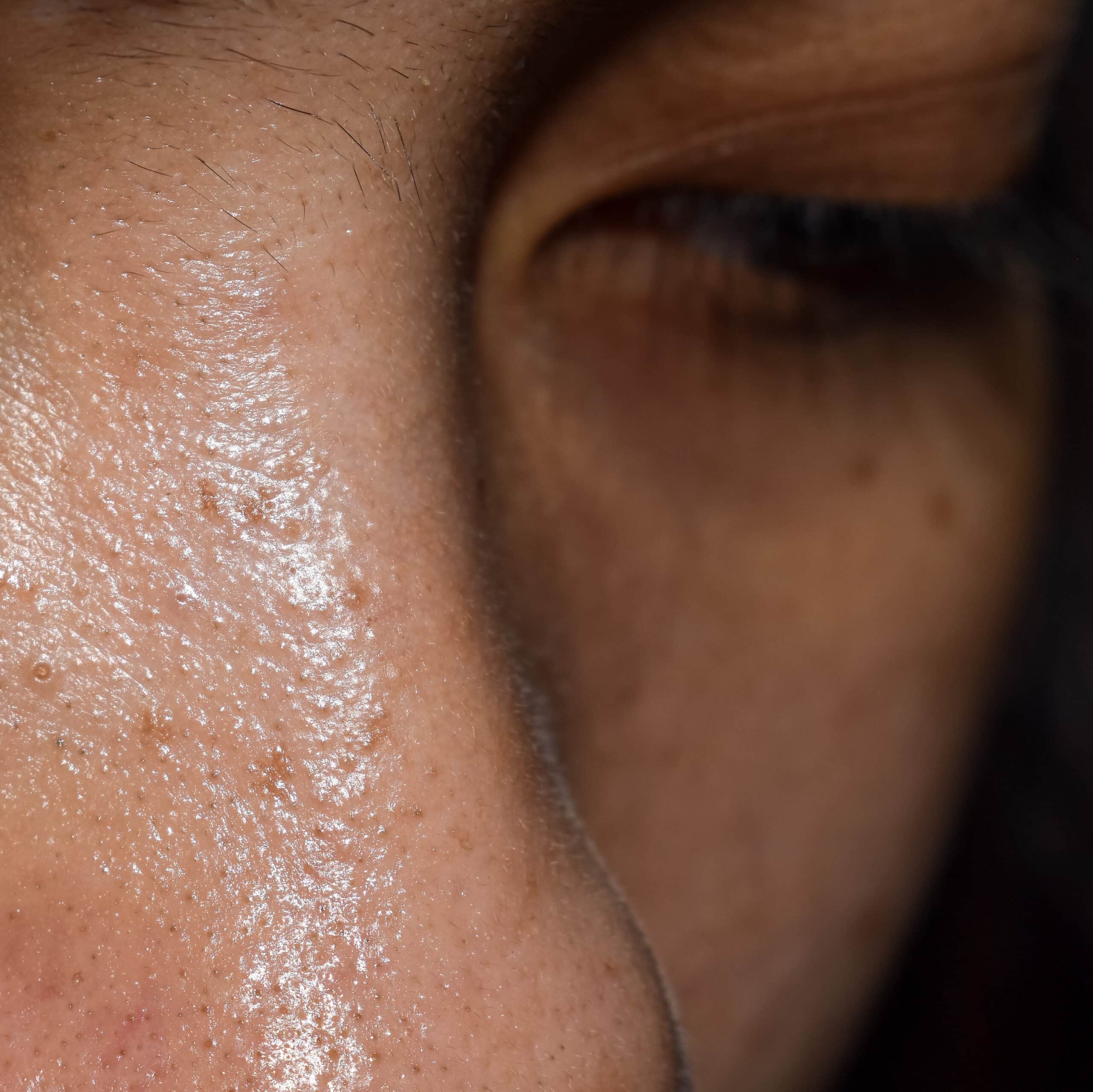 Sebaceous Filaments vs Blackheads: How to Identify and Treat