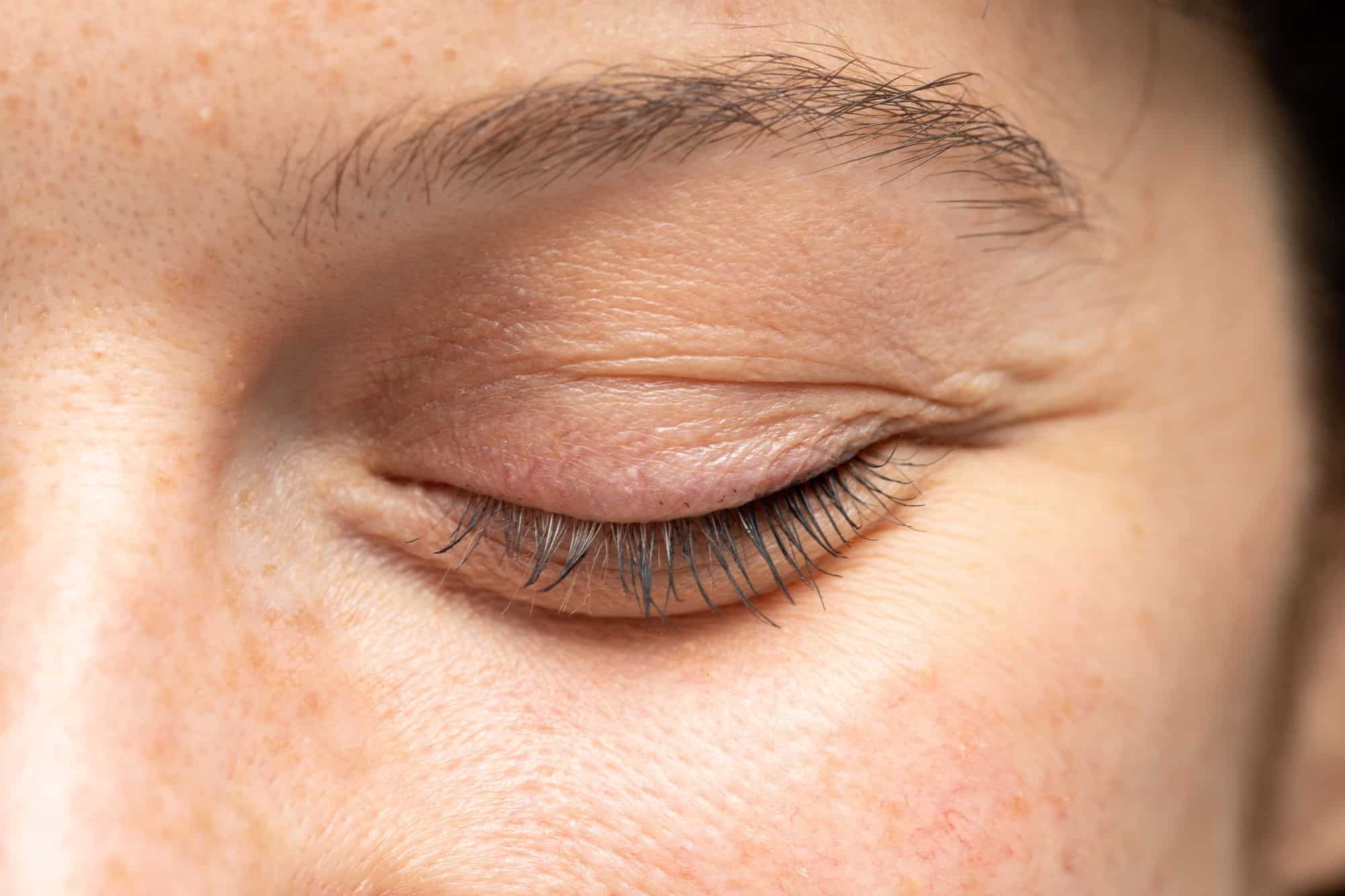 What Is Chemosis? Exploring Eye Swelling and How to Treat It ...