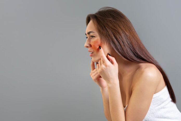 6 Ways to Handle Rosacea Gently and Improve Skin Over Time ...